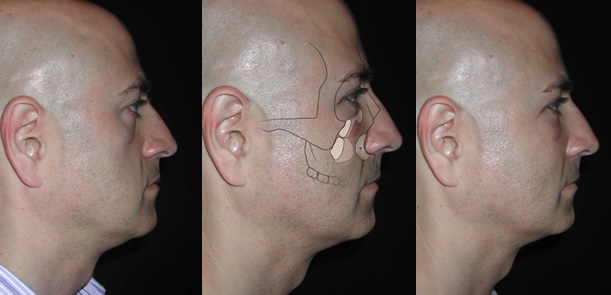 Making Concave Faces Convex – World Renowned Bespoke/Cosmetic Plastic ...