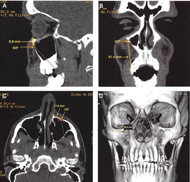 Infraorbital Nerve Function