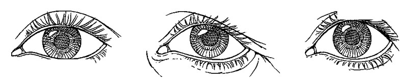 Upslanting Palpebral Fissures Images
